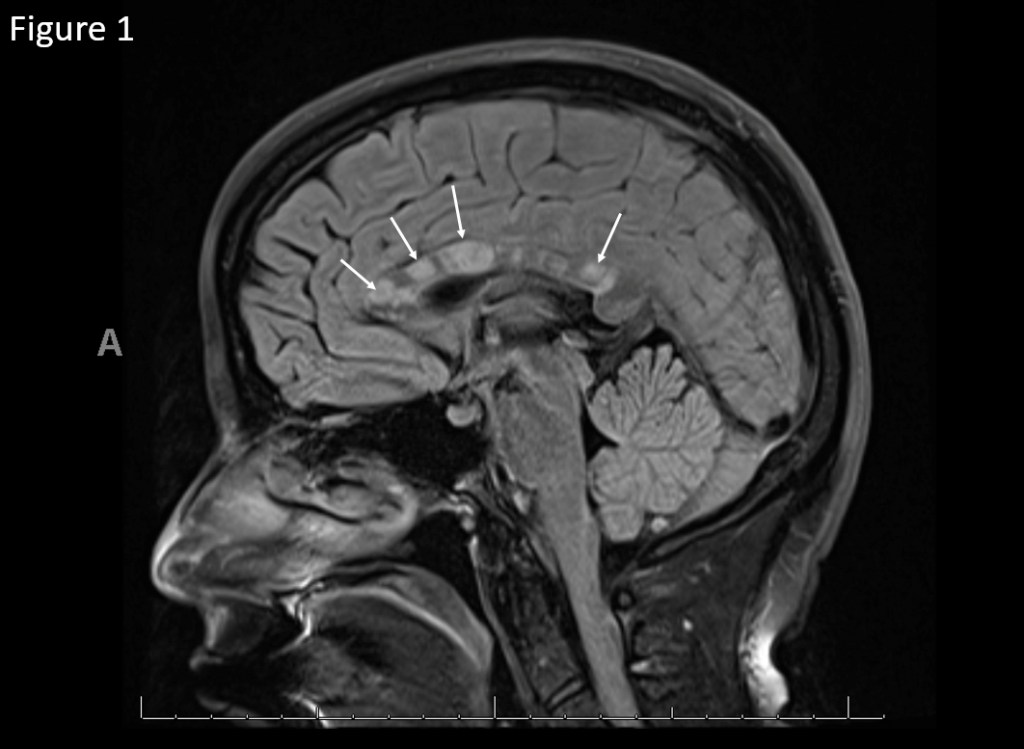 Moran CORE | Susac Syndrome