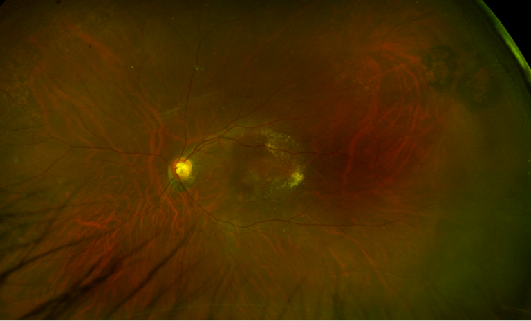 Moran CORE | Polypoidal Choroidal Vasculopathy Moran CORE | Polypoidal Choroidal Vasculopathy